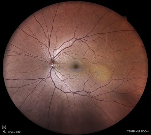 EIDON Ultra Wide-Field FAF Retinal Camera - Marketplace