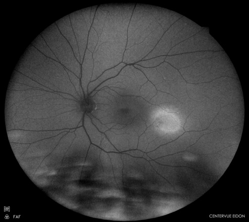 EIDON Ultra Wide-Field FAF Retinal Camera - Marketplace
